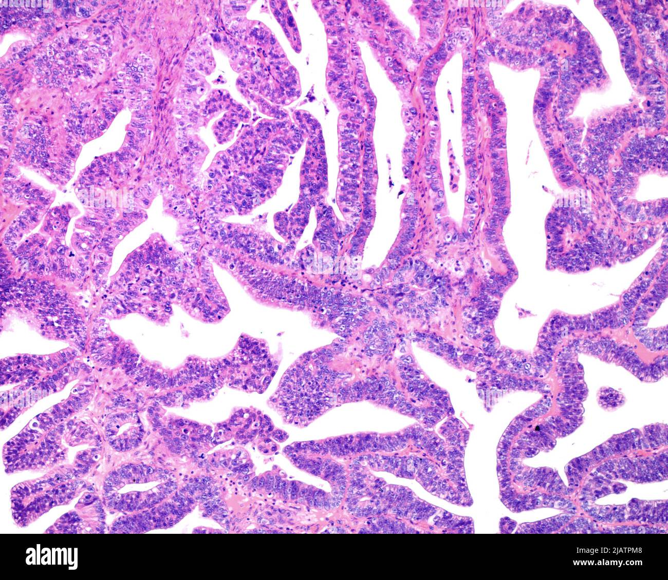 Ovarian mucinous cystadenoma, light micrograph Stock Photo - Alamy