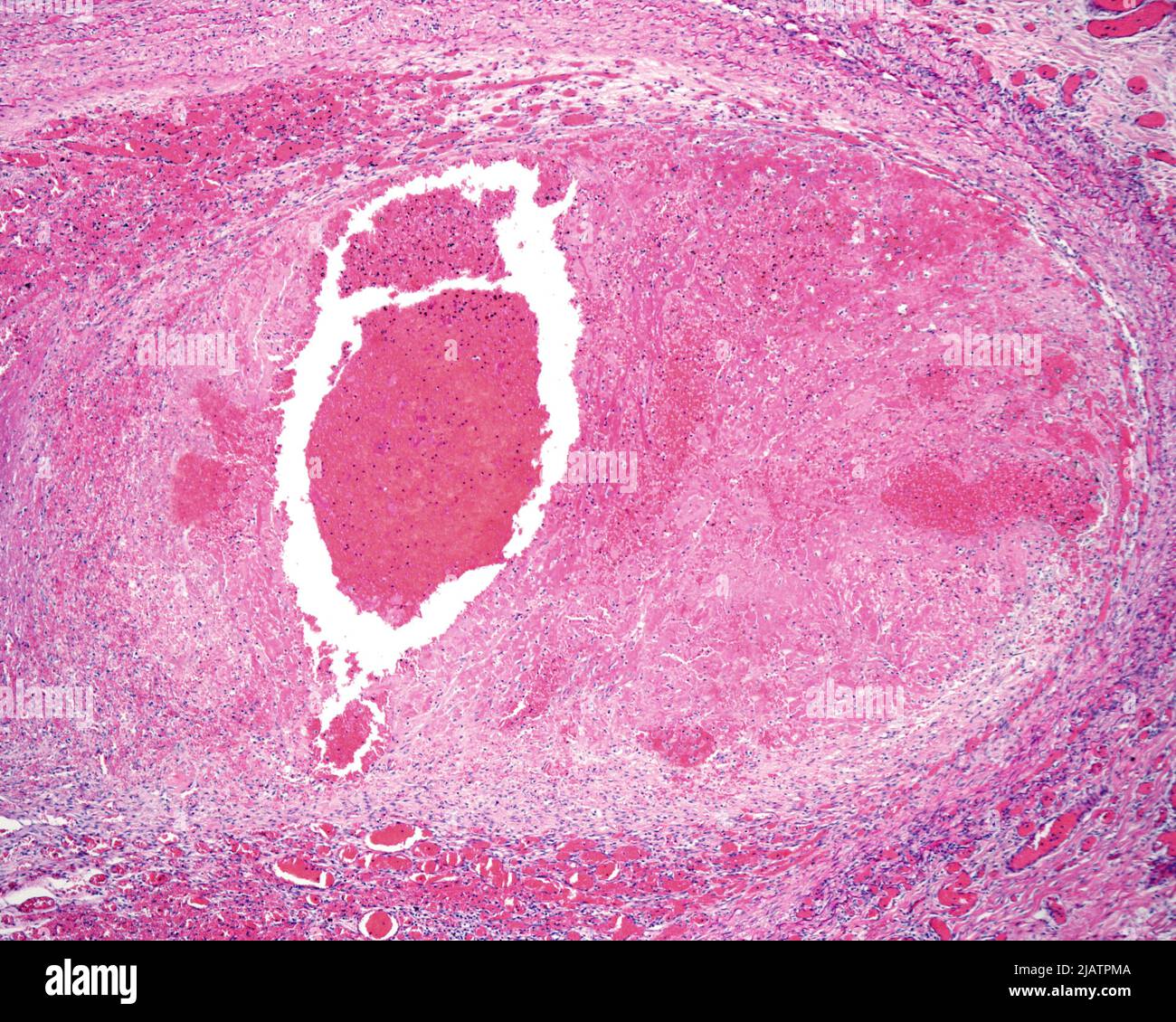 Arterial thrombosis, light micrograph Stock Photo - Alamy