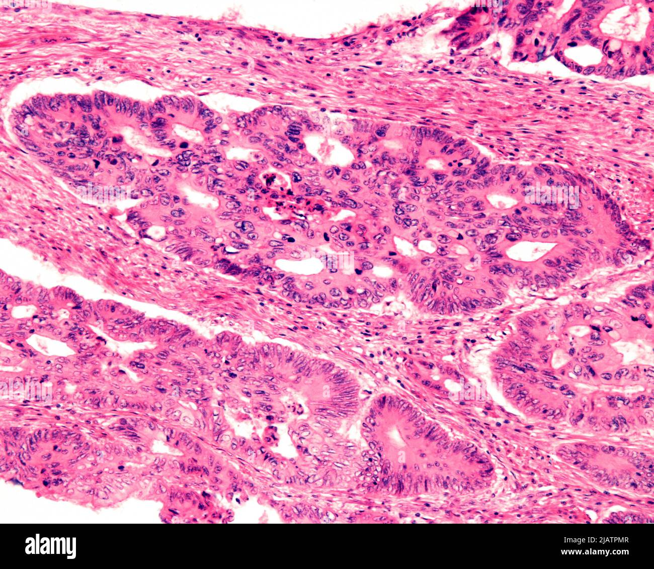 Adenocarcinoma in human colon, light micrograph Stock Photo - Alamy