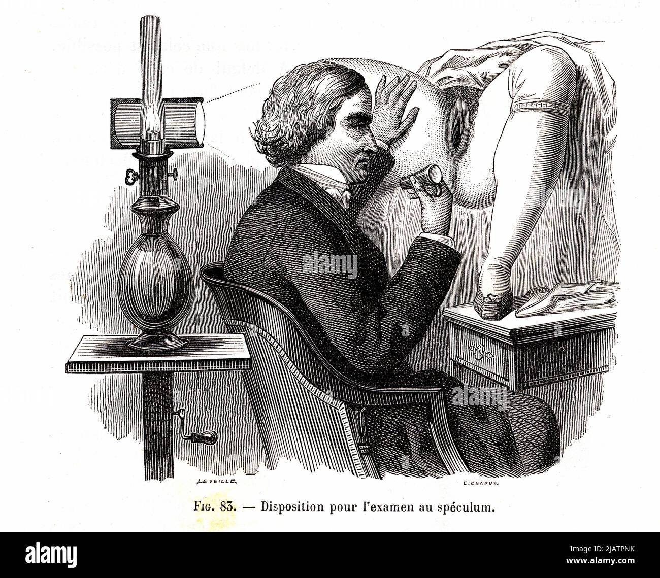 Examination using a vaginal speculum, illustration Stock Photo - Alamy