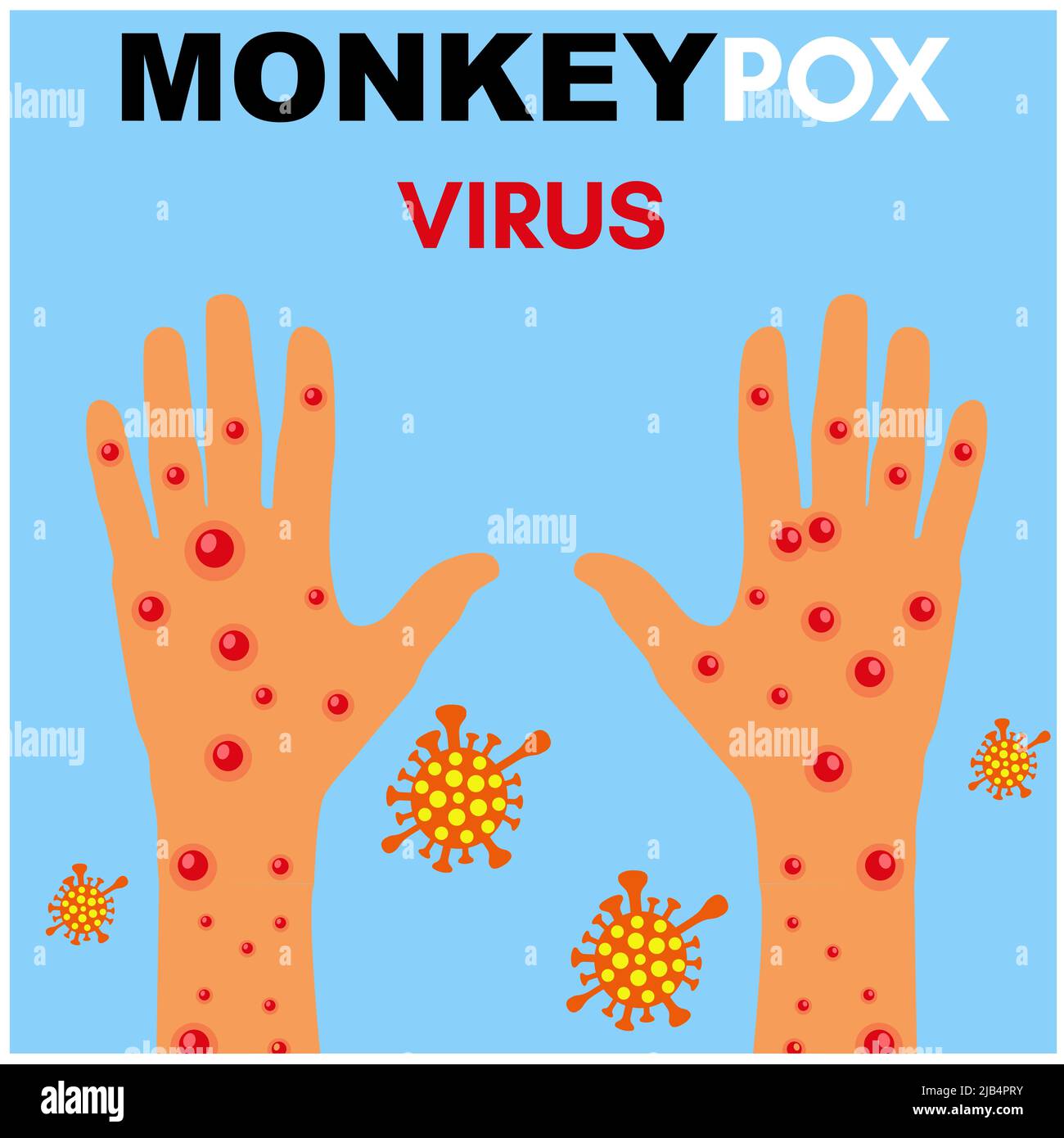 Monkeypox virus Illustration, vector of Hands with monkeypox, monkeypox ...