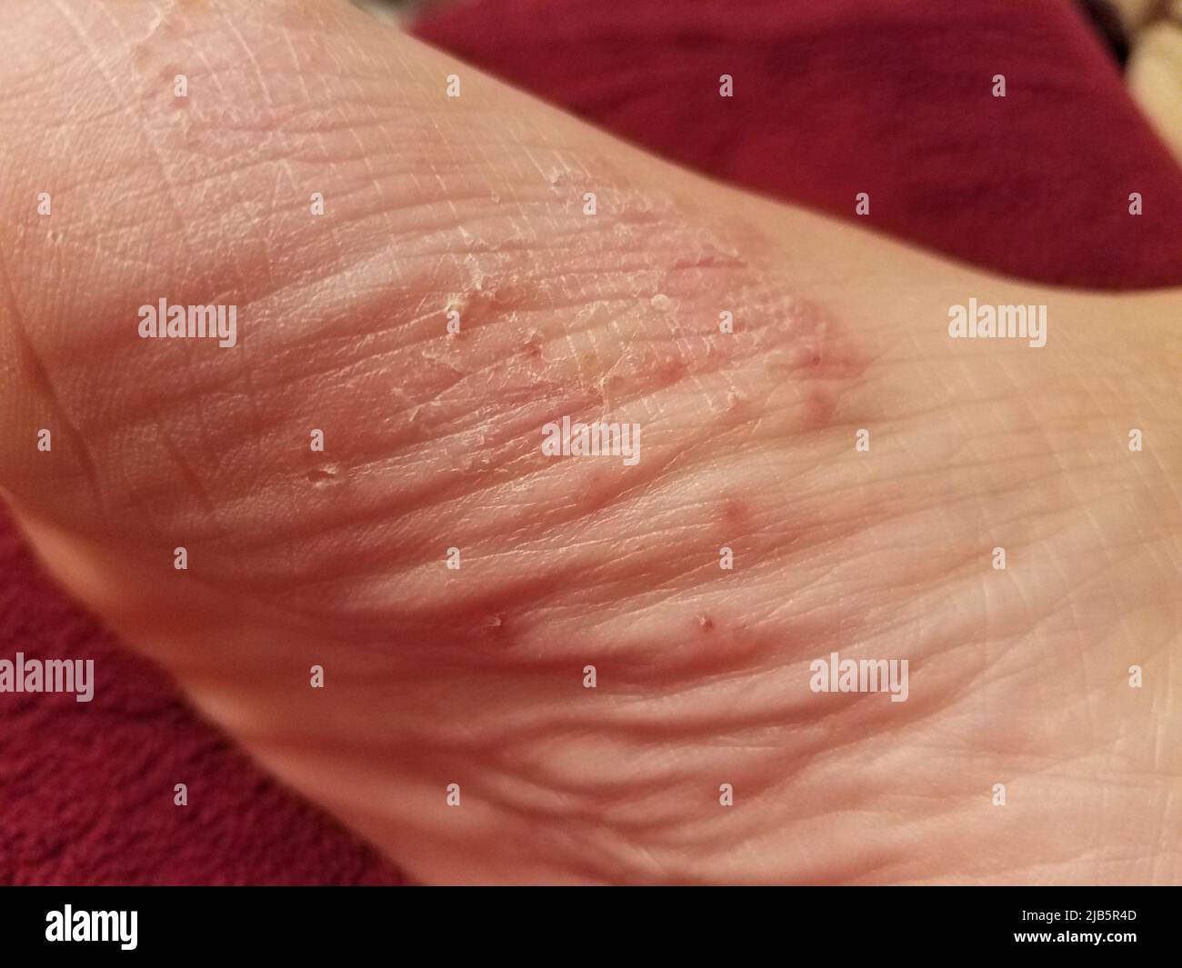 Foot fungus hi-res stock photography and images - Alamy