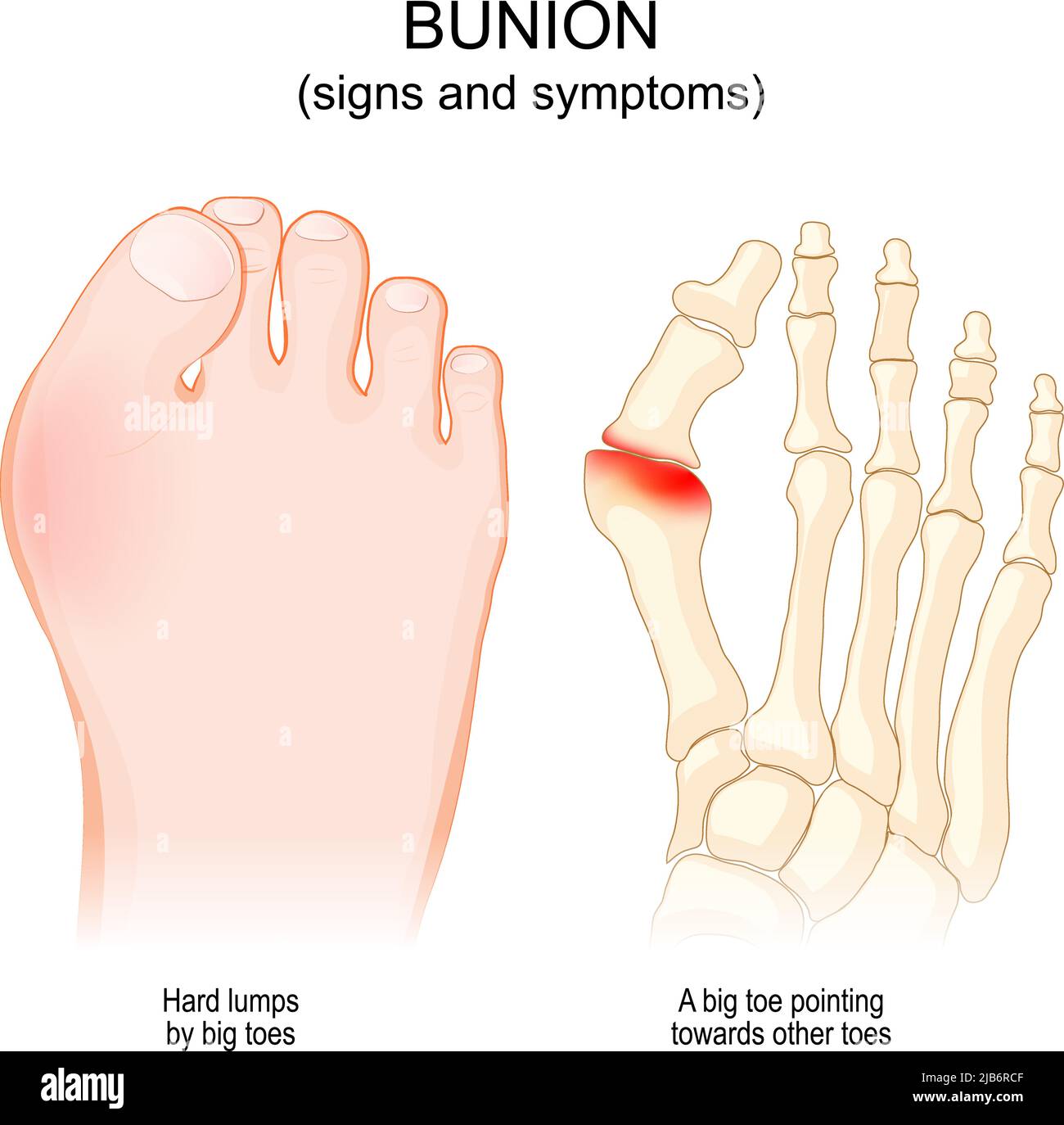Deformed leg Stock Vector Images - Alamy