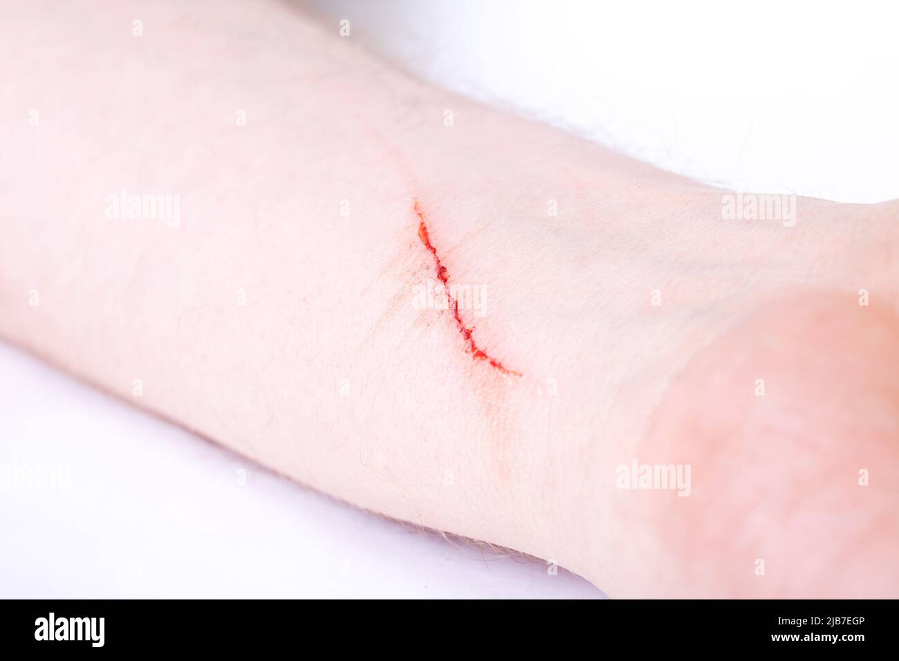 Bright scratch on the arm close up on white background Stock Photo - Alamy
