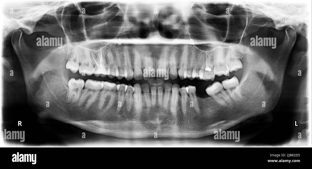 Orthopantomogram of the dentition, Panoramic x-ray of teeth, sixth ...
