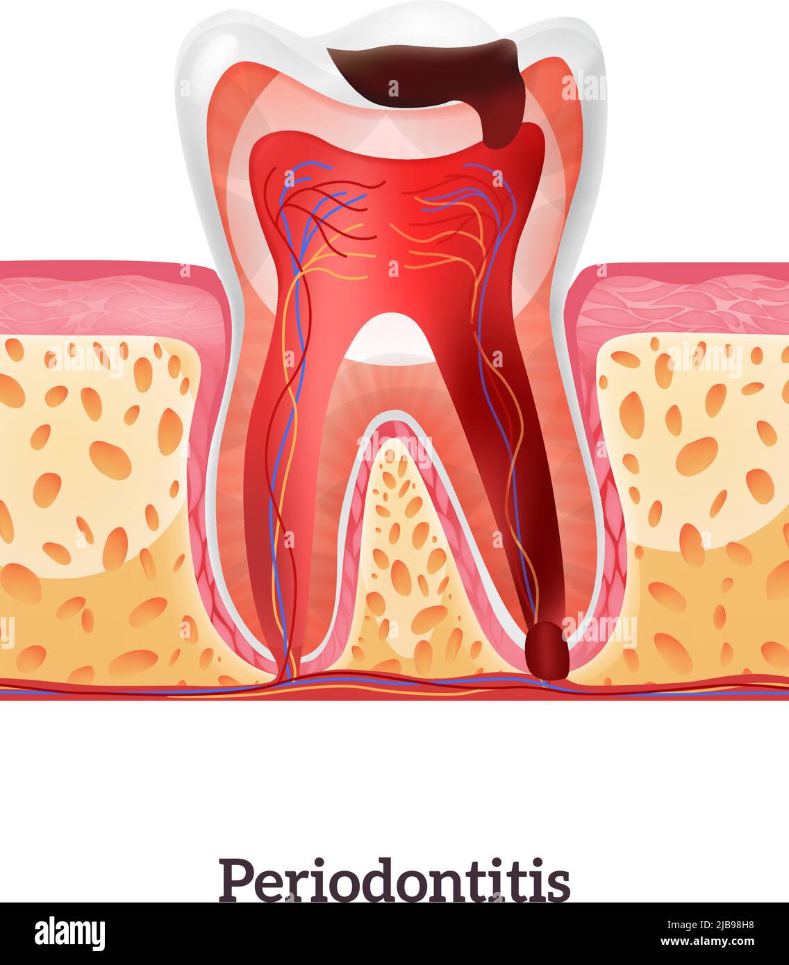 Unhealthy tooth with periodontitis realistic vector illustration Stock ...