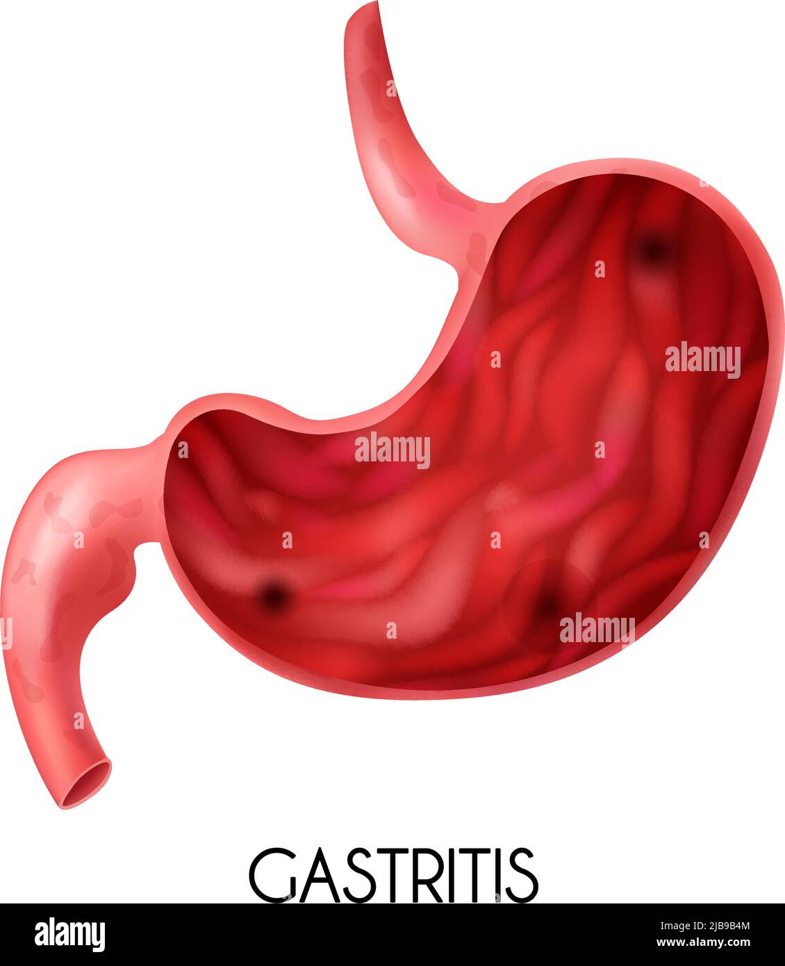 Realistic medical image of human stomach with gastritis on white ...