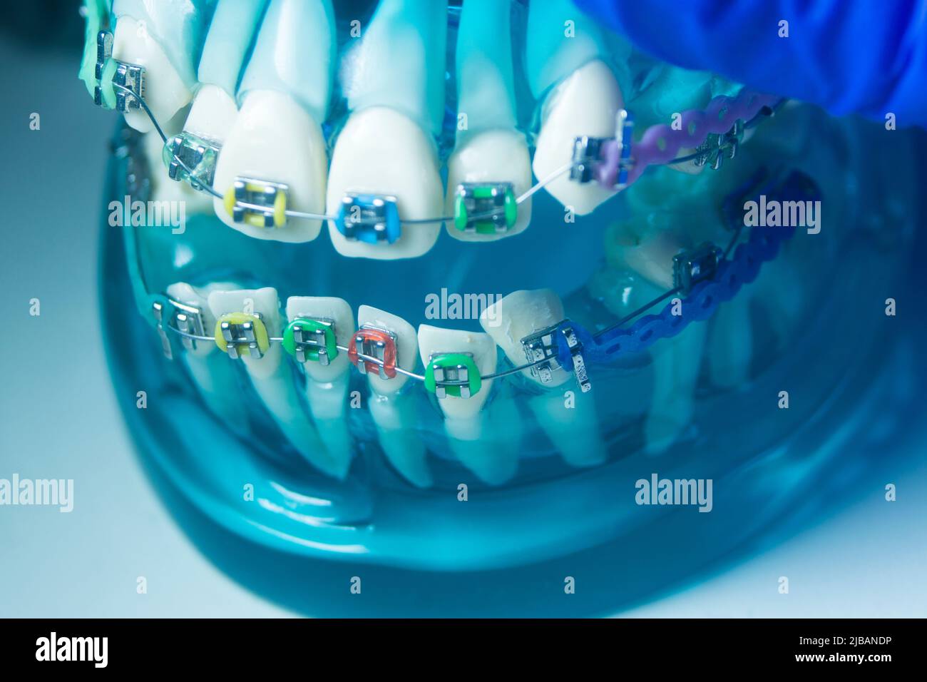 Modern metal brackets aligner straighterners used to correct alignment ...