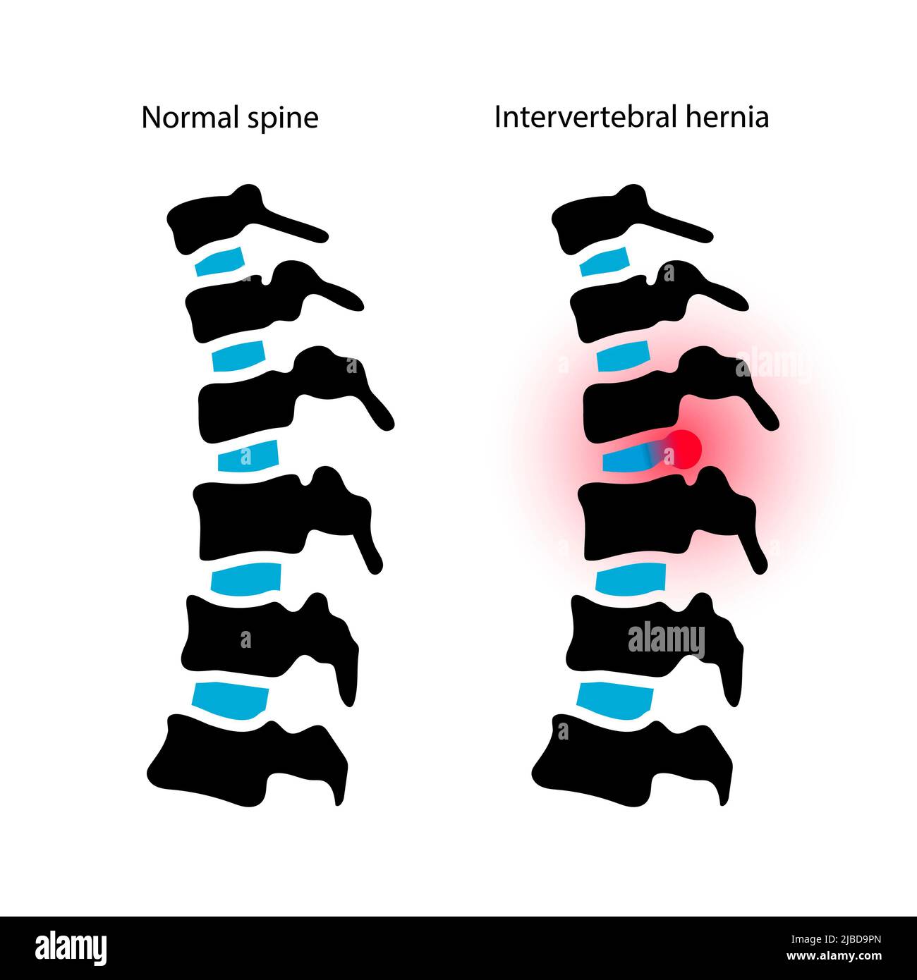 Intervertebral disc herniation Cut Out Stock Images & Pictures - Alamy
