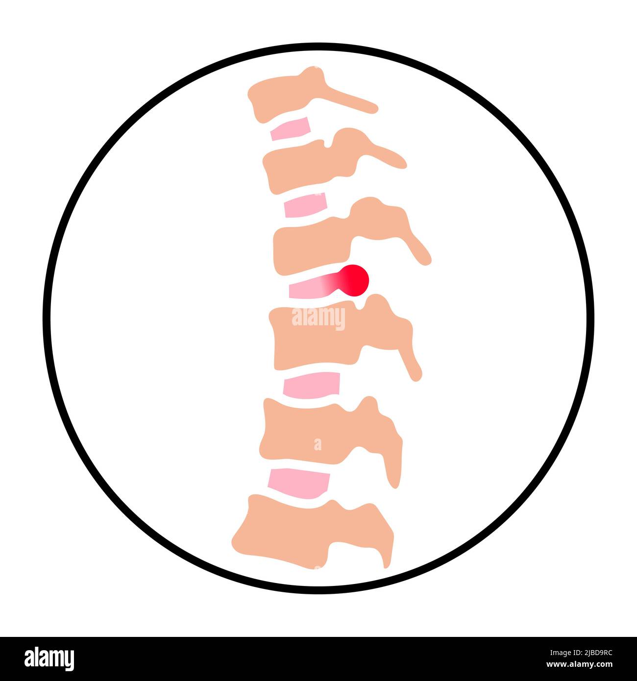 Intervertebral hernia, illustration Stock Photo - Alamy