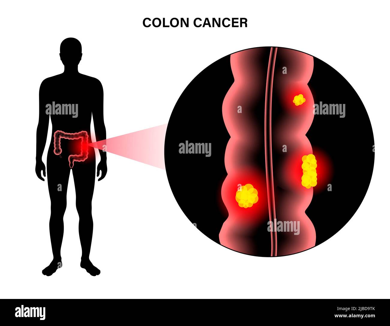 Intestinal cancer, illustration Stock Photo - Alamy