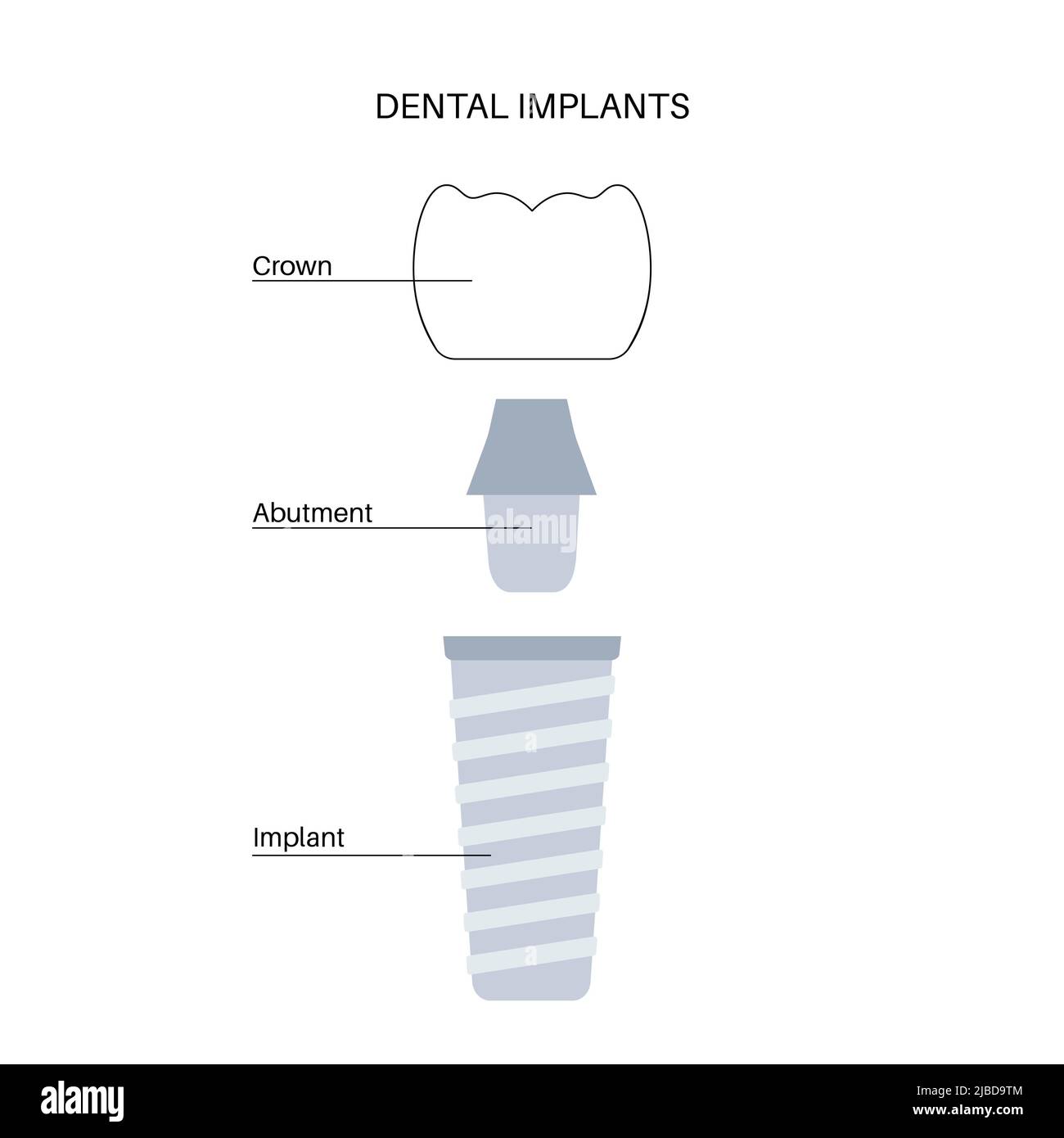 Dental implant, illustration Stock Photo - Alamy