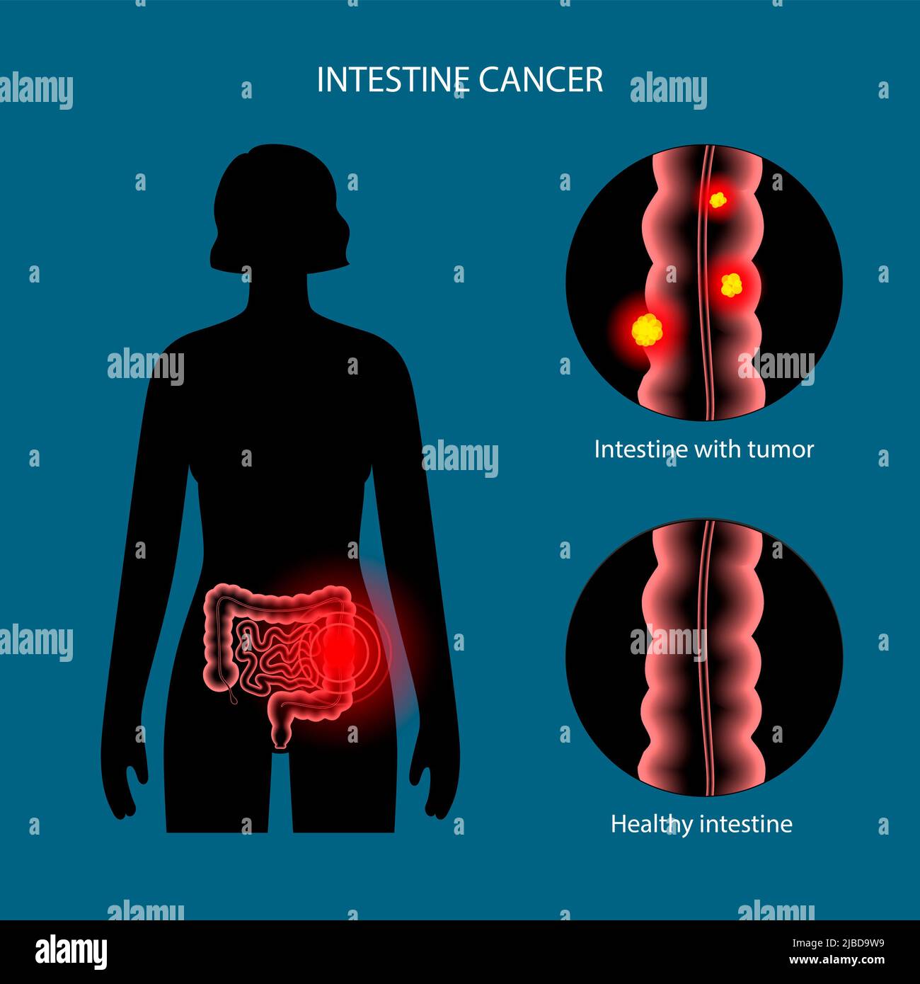 Intestinal cancer, illustration Stock Photo - Alamy