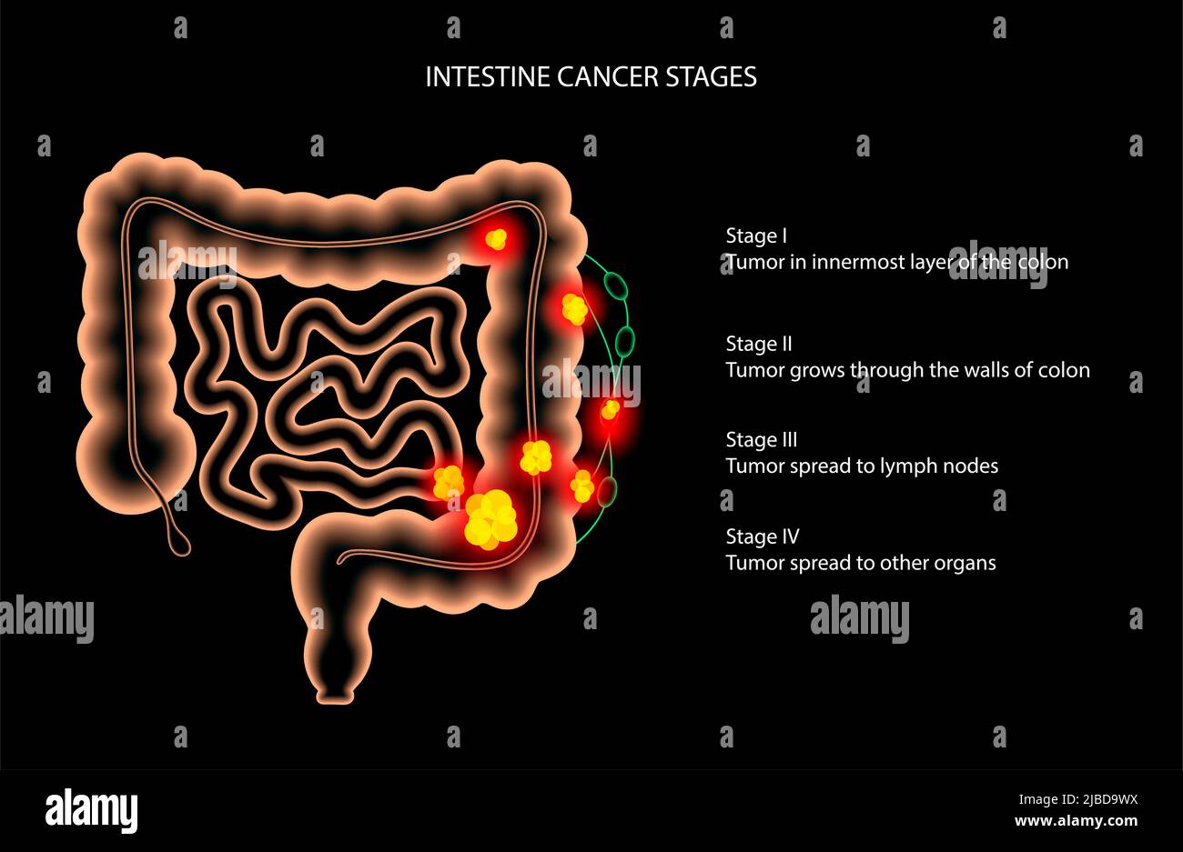 Intestinal cancer, illustration Stock Photo - Alamy