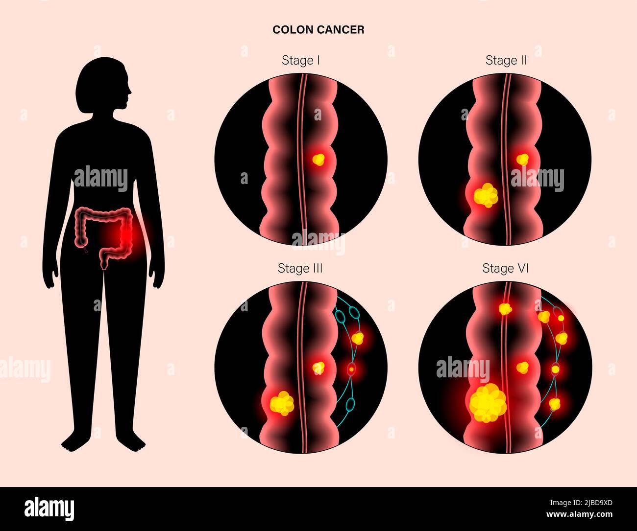 Intestinal cancer, illustration Stock Photo - Alamy