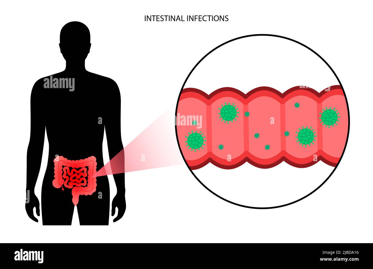 Intestinal infection, illustration Stock Photo - Alamy