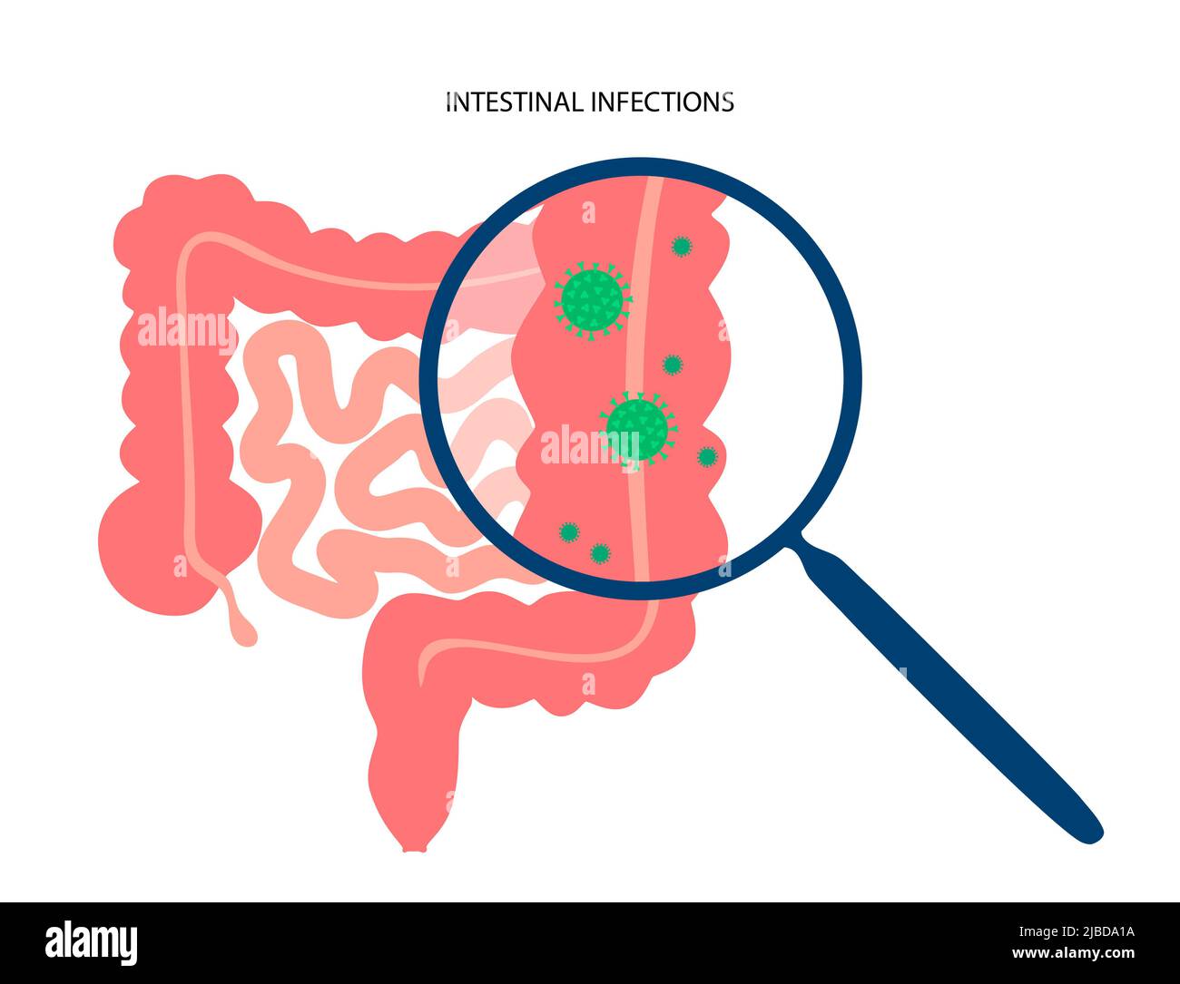 Intestinal infection, illustration Stock Photo - Alamy
