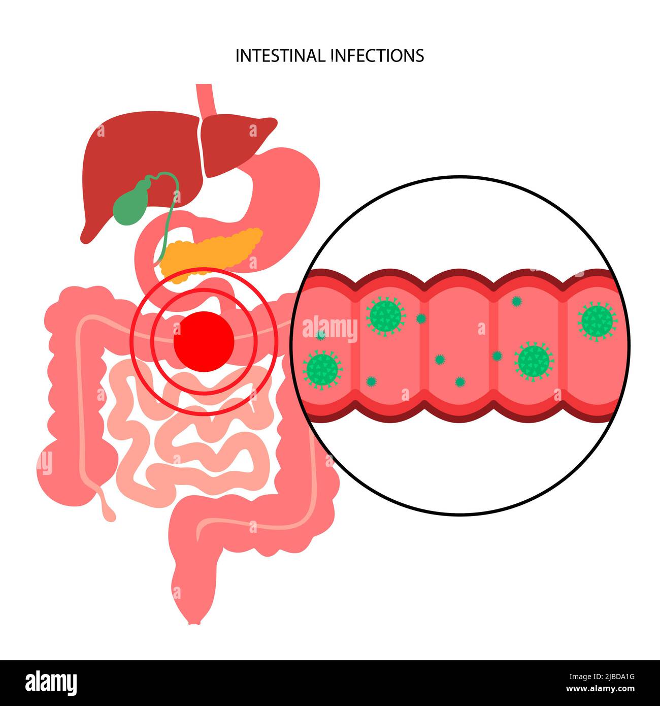 Intestinal infection, illustration Stock Photo - Alamy