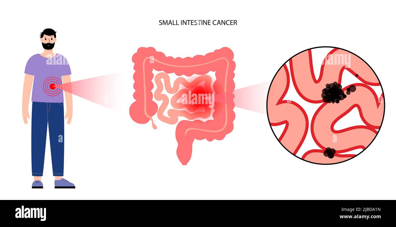 Small intestine cancer, illustration Stock Photo - Alamy