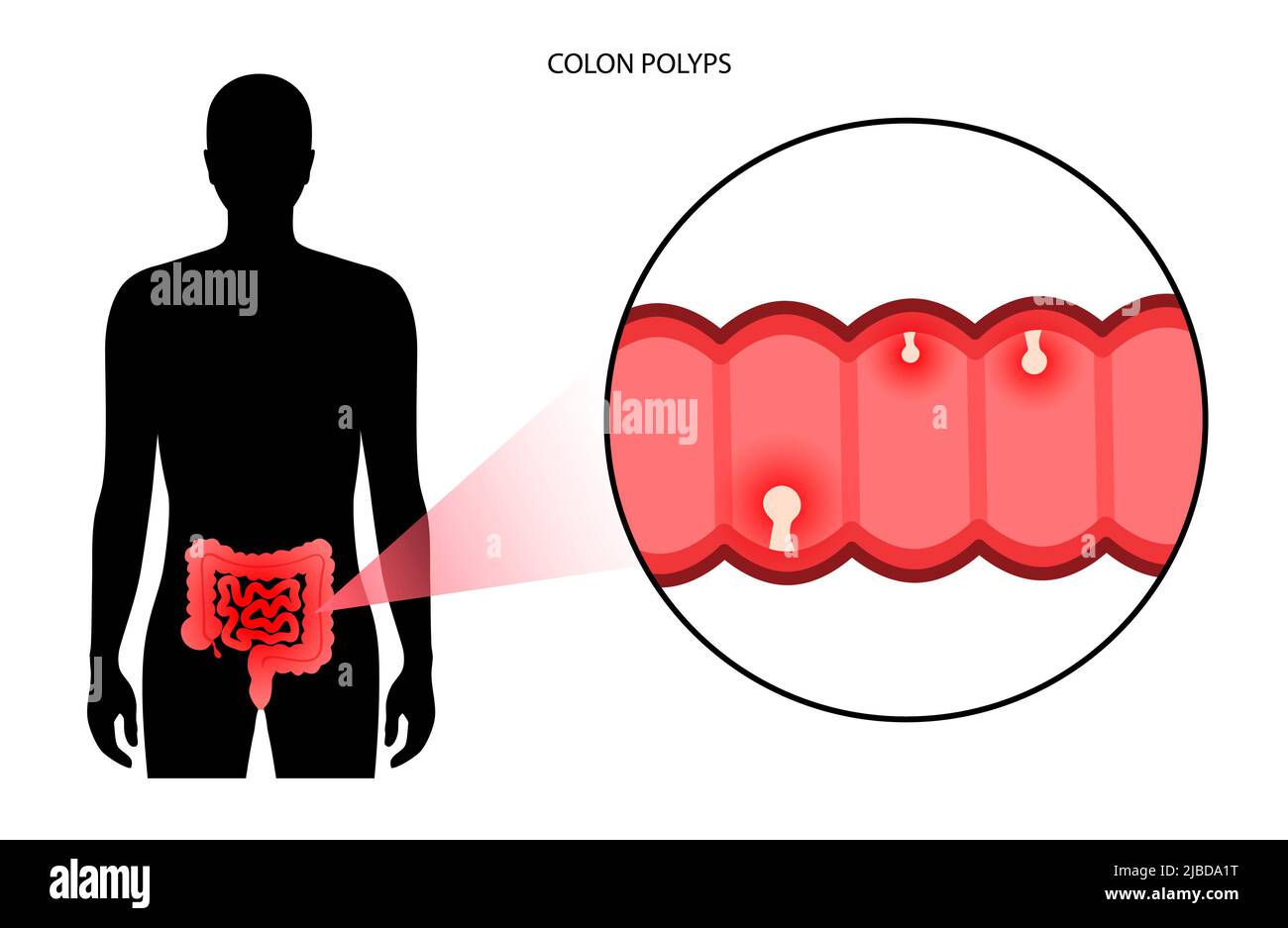 Colon polyps, illustration Stock Photo - Alamy