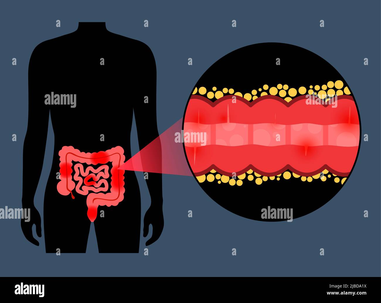Chron's disease, conceptual illustration Stock Photo - Alamy