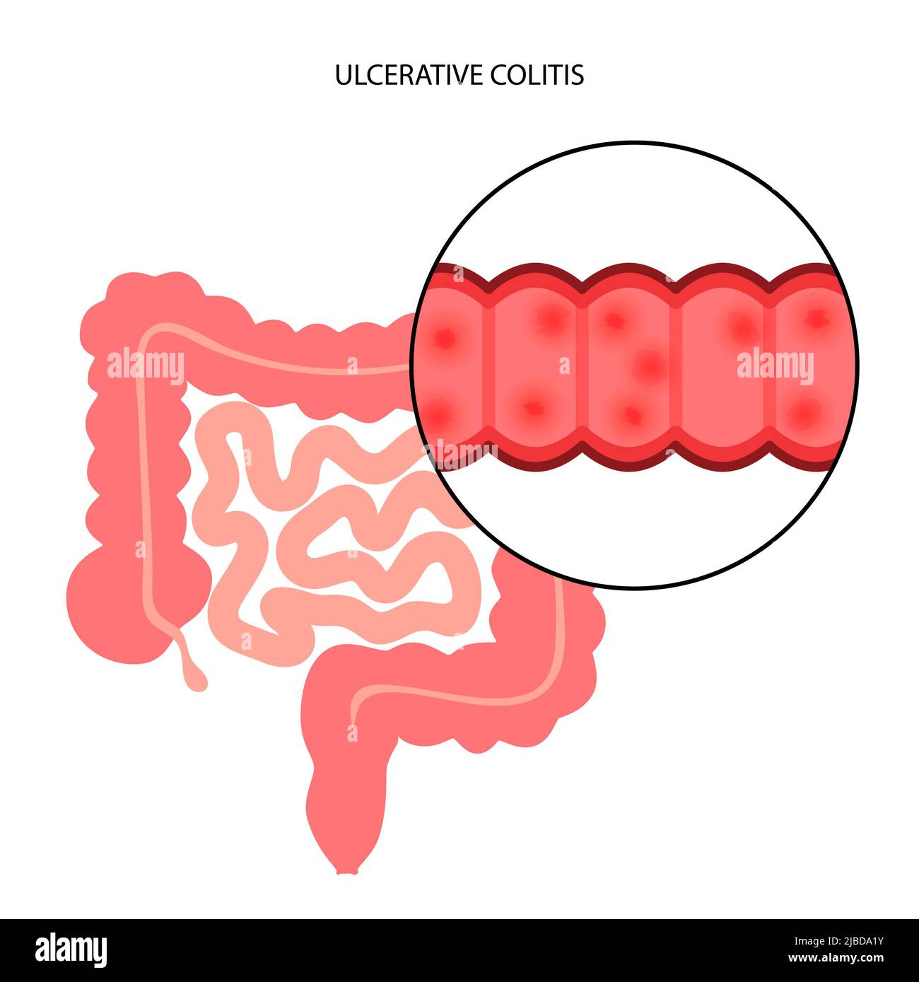 Ulcerative colitis, illustration Stock Photo - Alamy