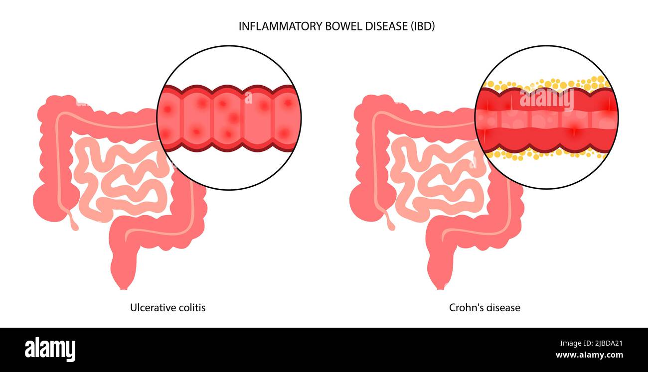 Inflammatory bowel disease, illustration Stock Photo - Alamy