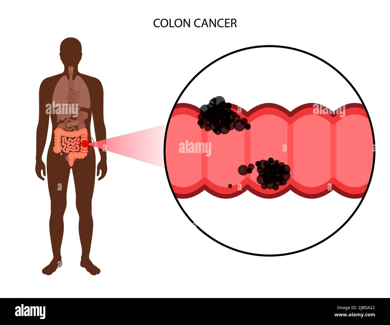 Colon cancer stages, illustration Stock Photo - Alamy