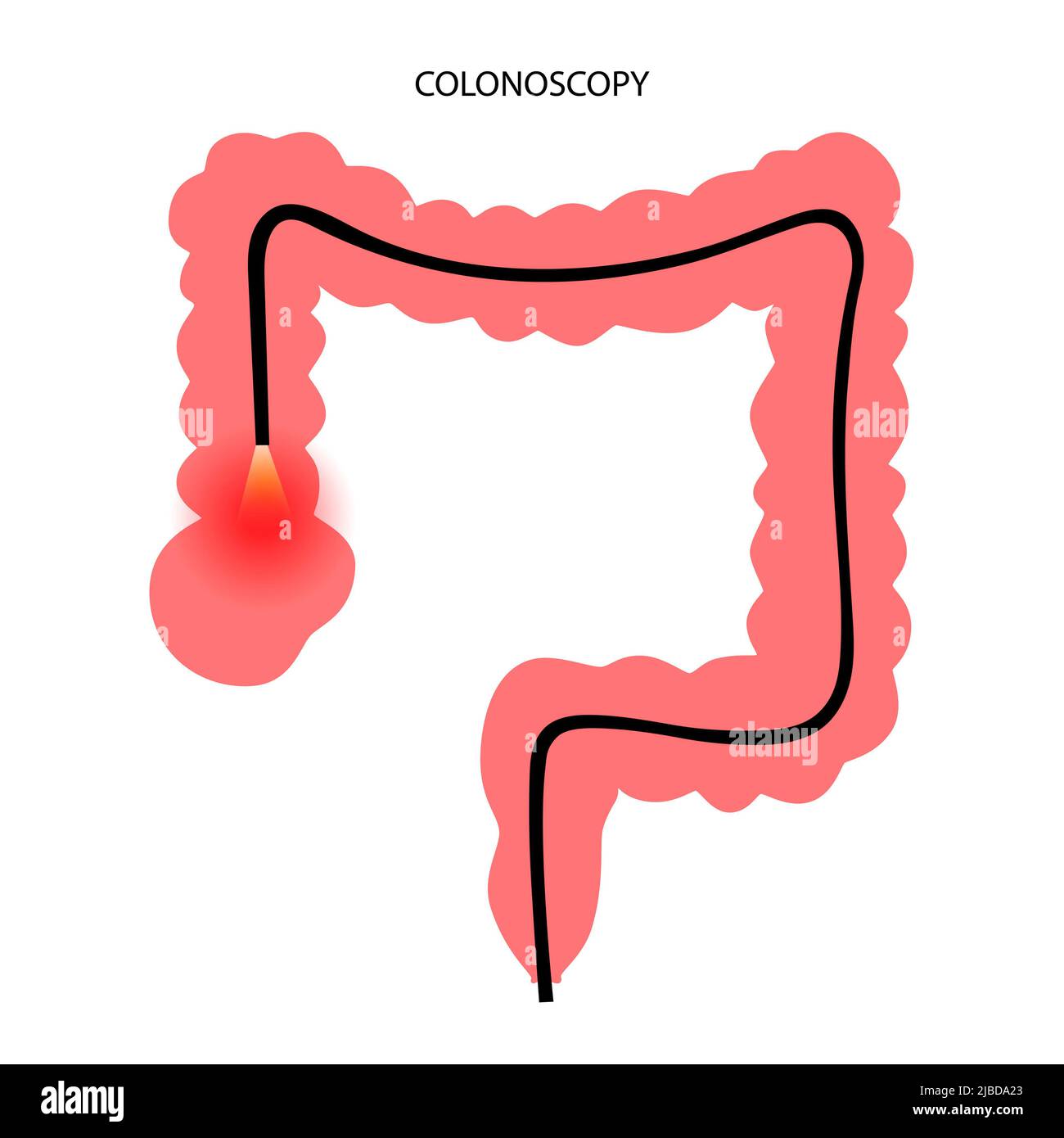 Large intestine endoscopy hi-res stock photography and images - Alamy