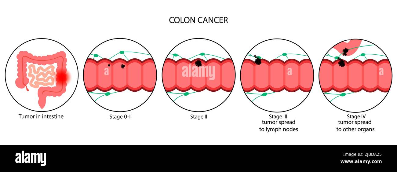 Colon cancer stages, illustration Stock Photo - Alamy