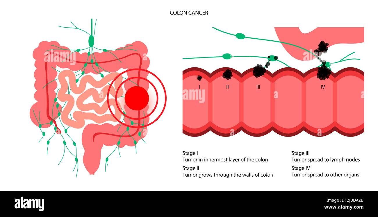 Colon cancer stages, illustration Stock Photo - Alamy