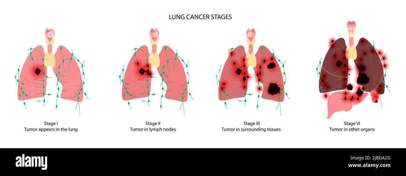 Lung cancer tissue Cut Out Stock Images & Pictures - Alamy