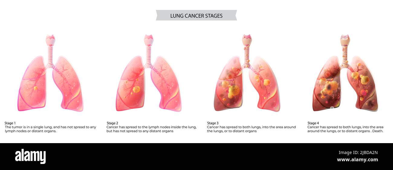 Lung cancer tissue Cut Out Stock Images & Pictures - Alamy
