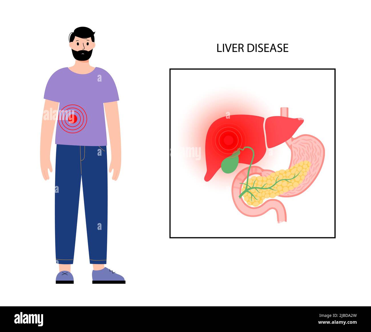 Liver disease, illustration Stock Photo - Alamy