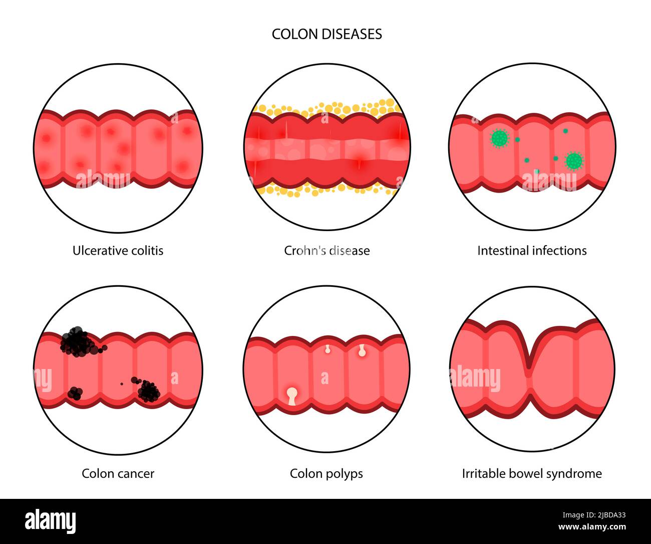 Intestinal diseases, illustration Stock Photo - Alamy