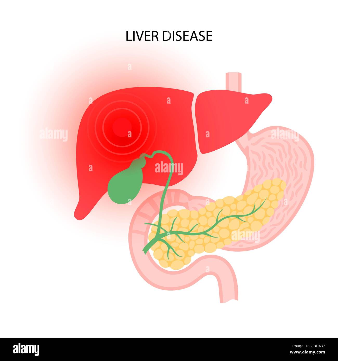 Liver disease, illustration Stock Photo - Alamy