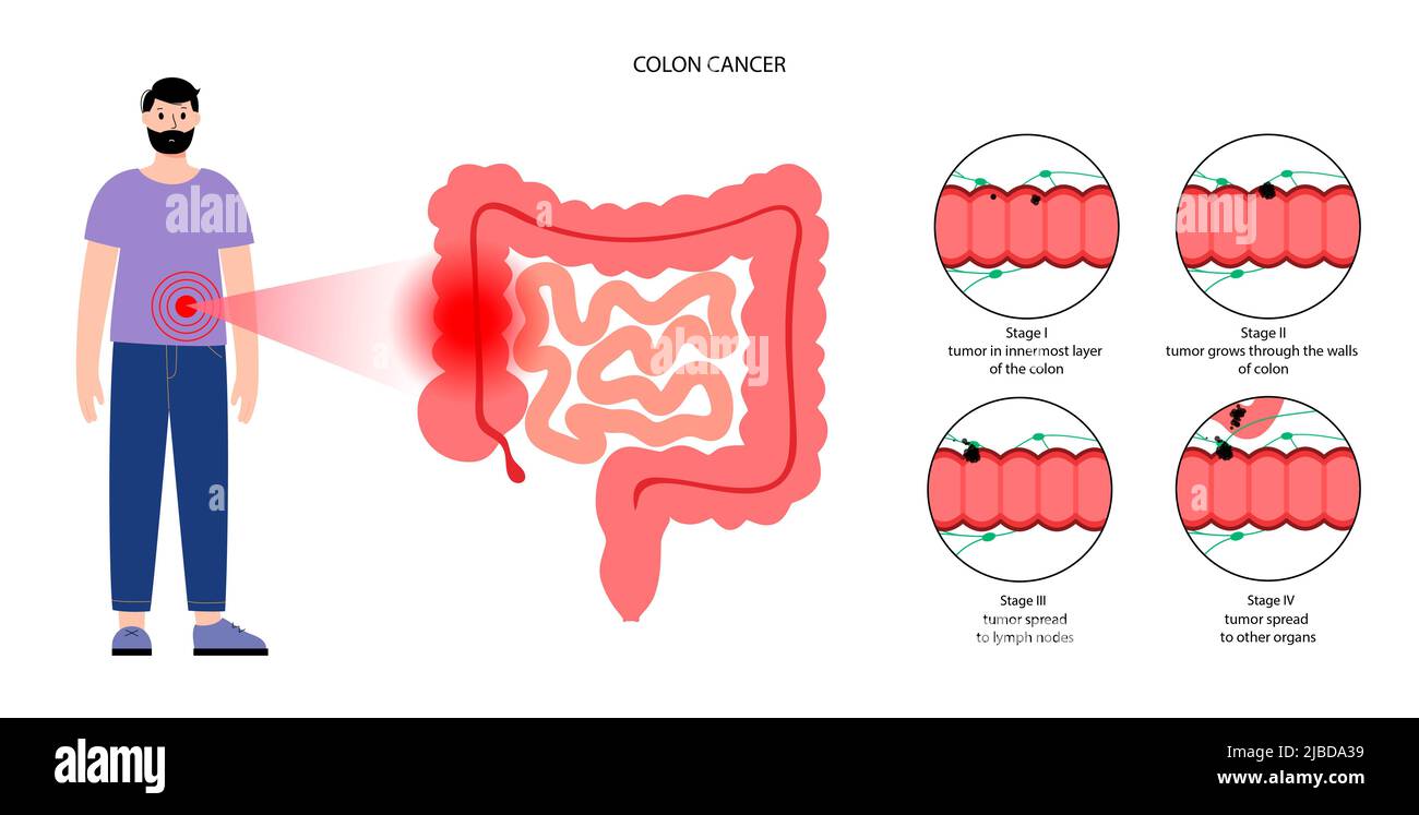 Colon cancer stages, illustration Stock Photo - Alamy