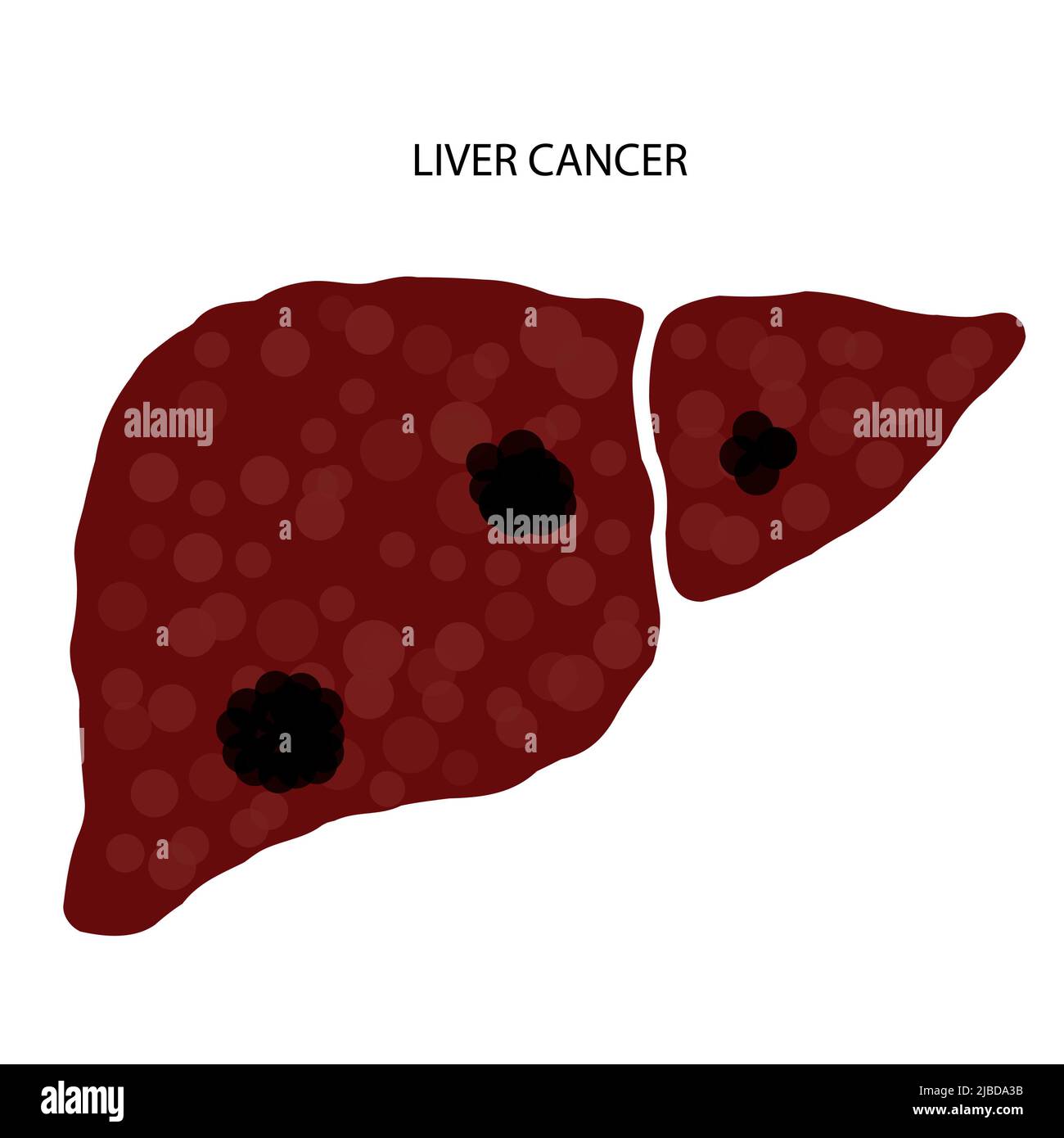 Liver disease, illustration Stock Photo - Alamy