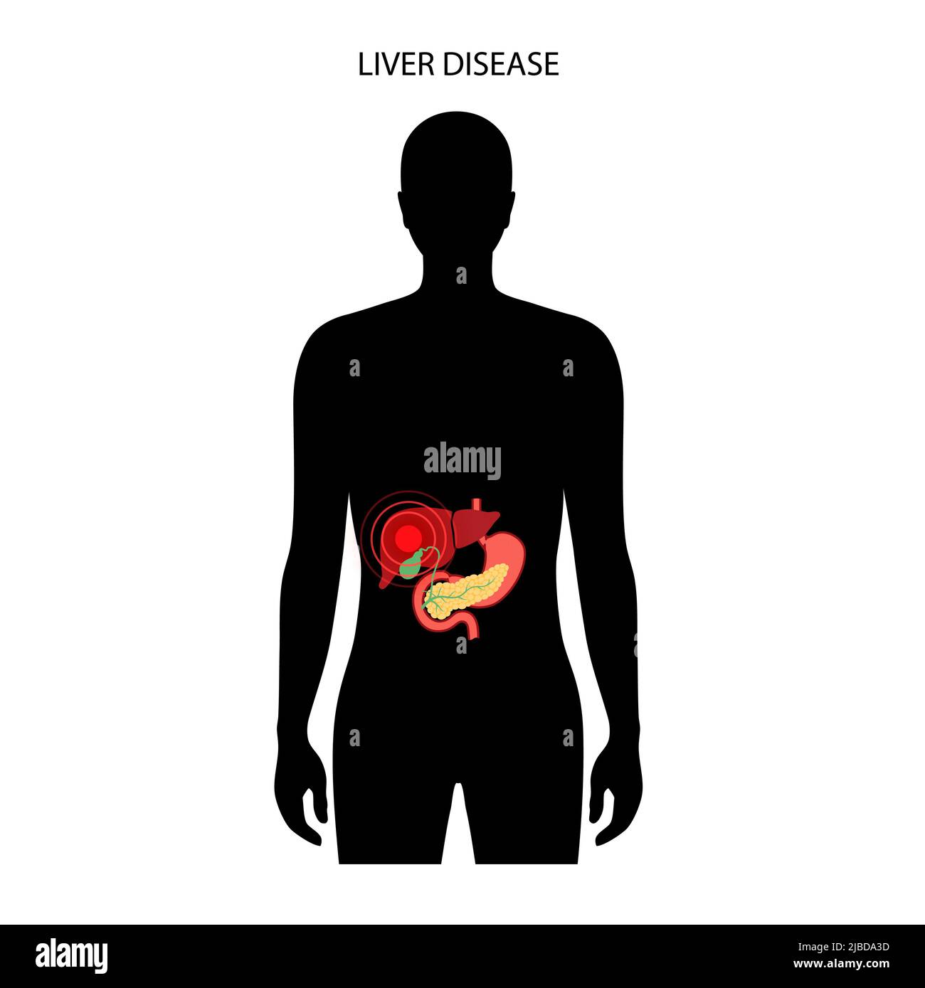Liver disease, illustration Stock Photo - Alamy