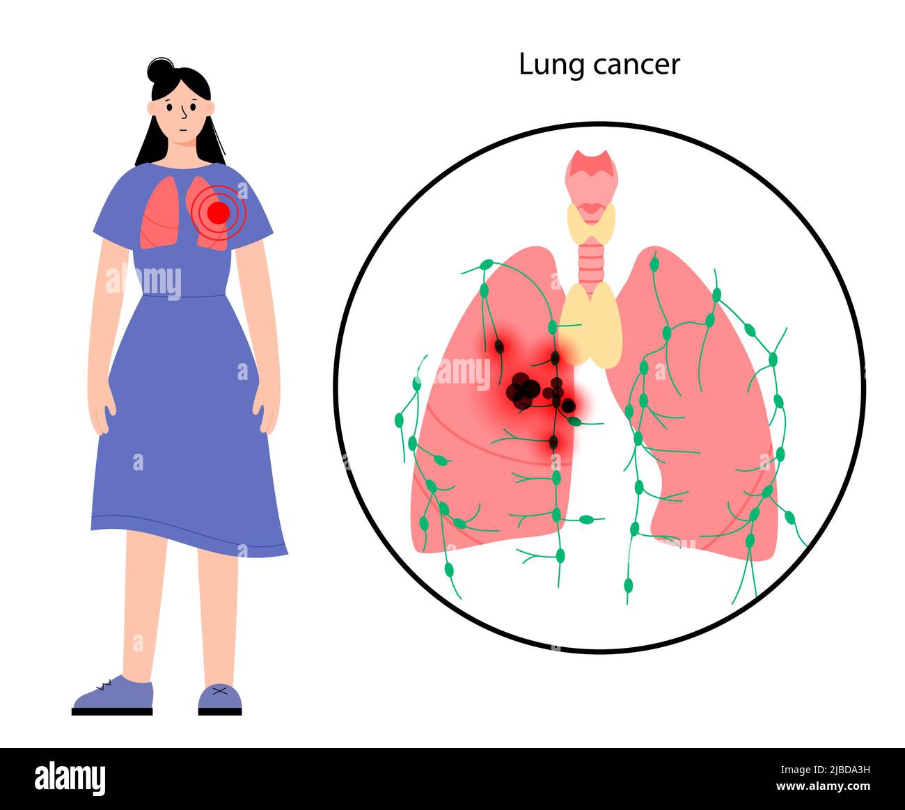 Lungs cancer, illustration Stock Photo - Alamy