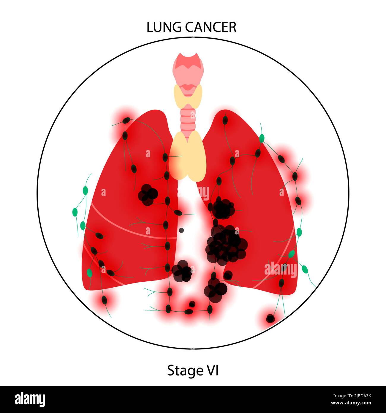 Lung cancer tissue Cut Out Stock Images & Pictures - Alamy