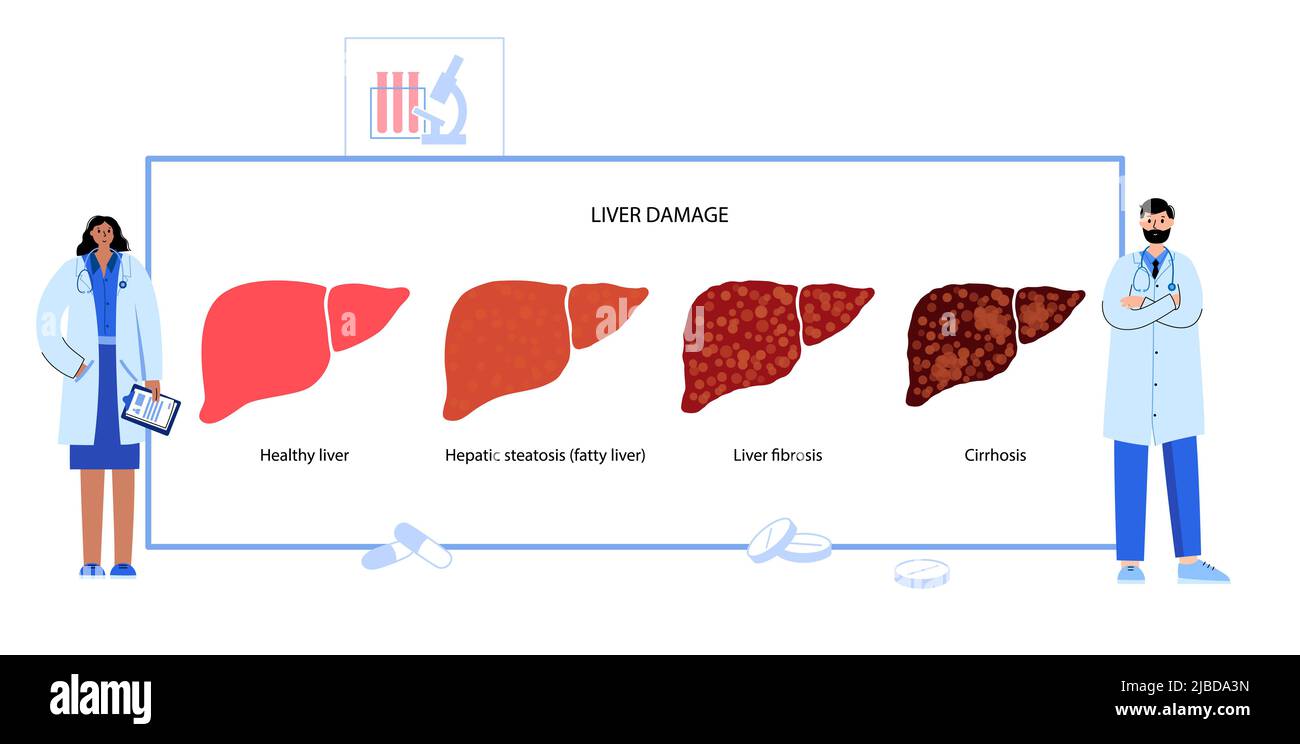 Liver disease, illustration Stock Photo - Alamy