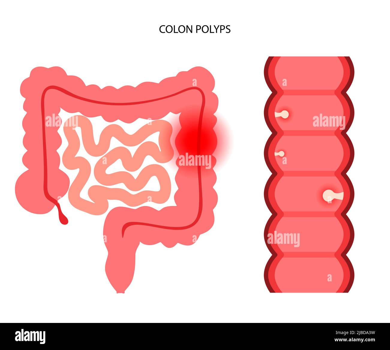 Small polyps Cut Out Stock Images & Pictures - Alamy