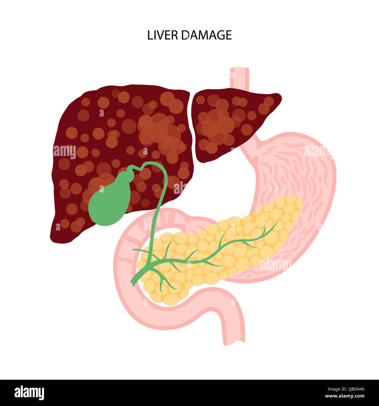 Liver disease, illustration Stock Photo - Alamy