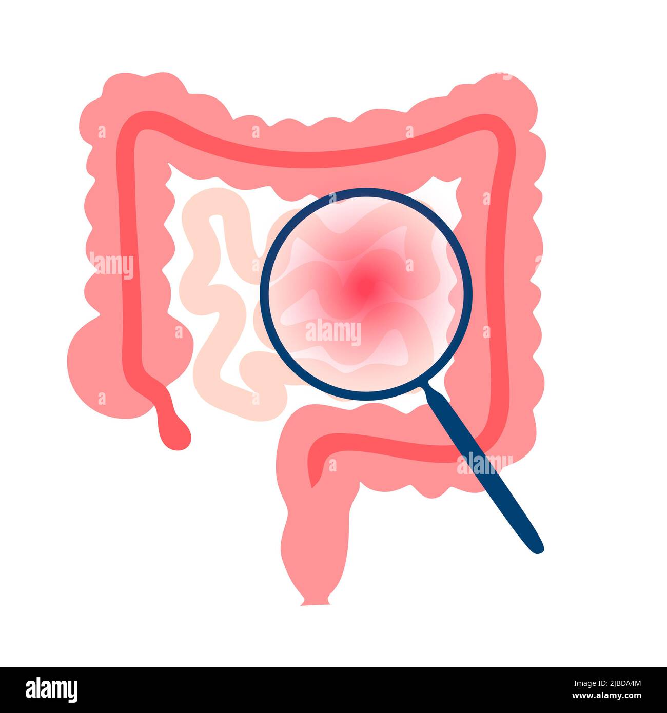 Intestinal diseases, illustration Stock Photo - Alamy