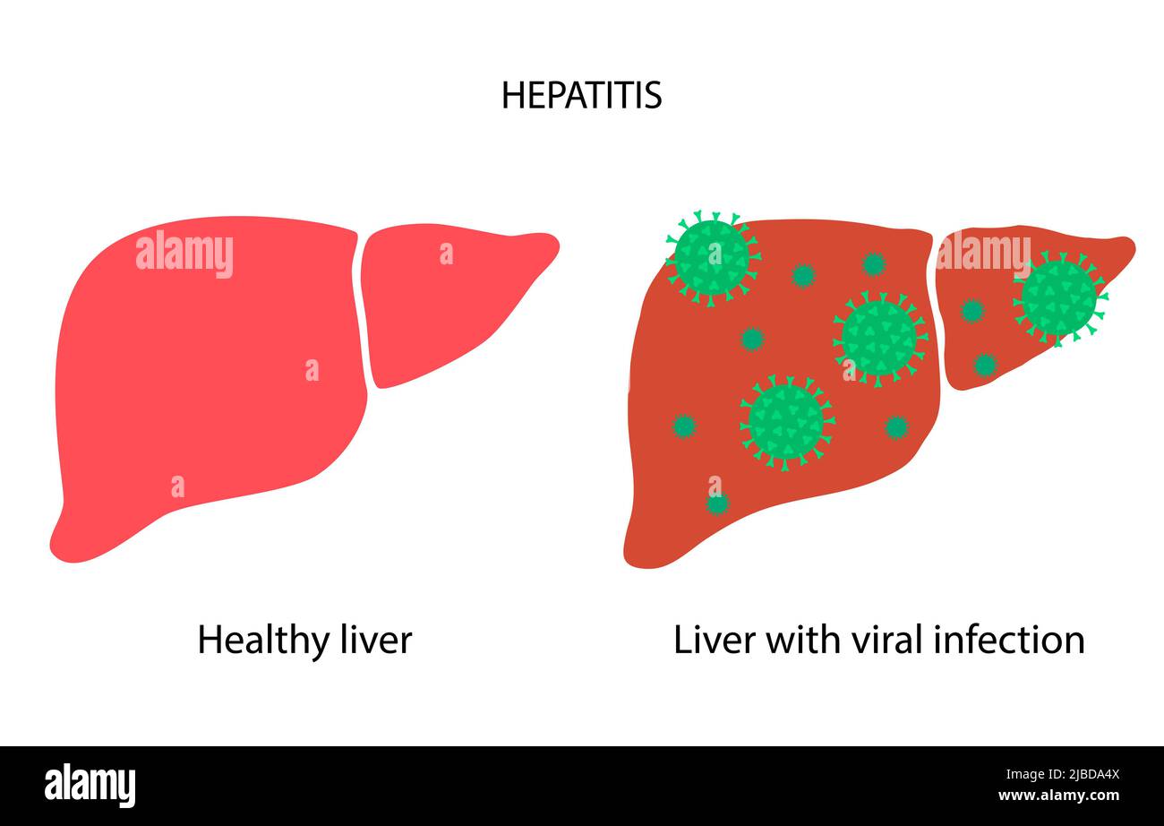 Liver disease, illustration Stock Photo - Alamy