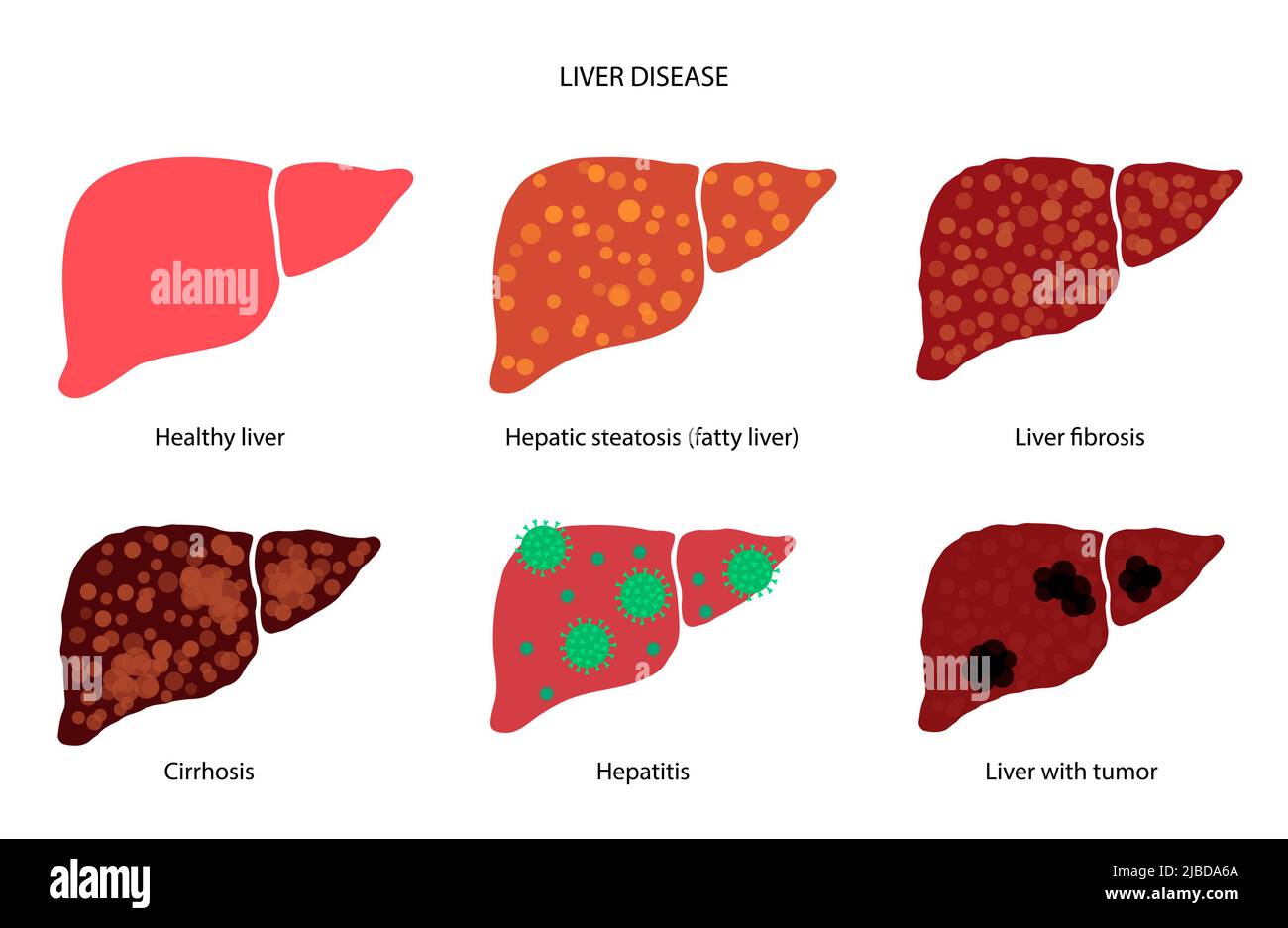 Liver disease, illustration Stock Photo - Alamy