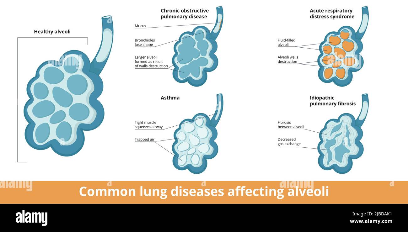 Common alveoli damages. Differences between changes caused by lung ...