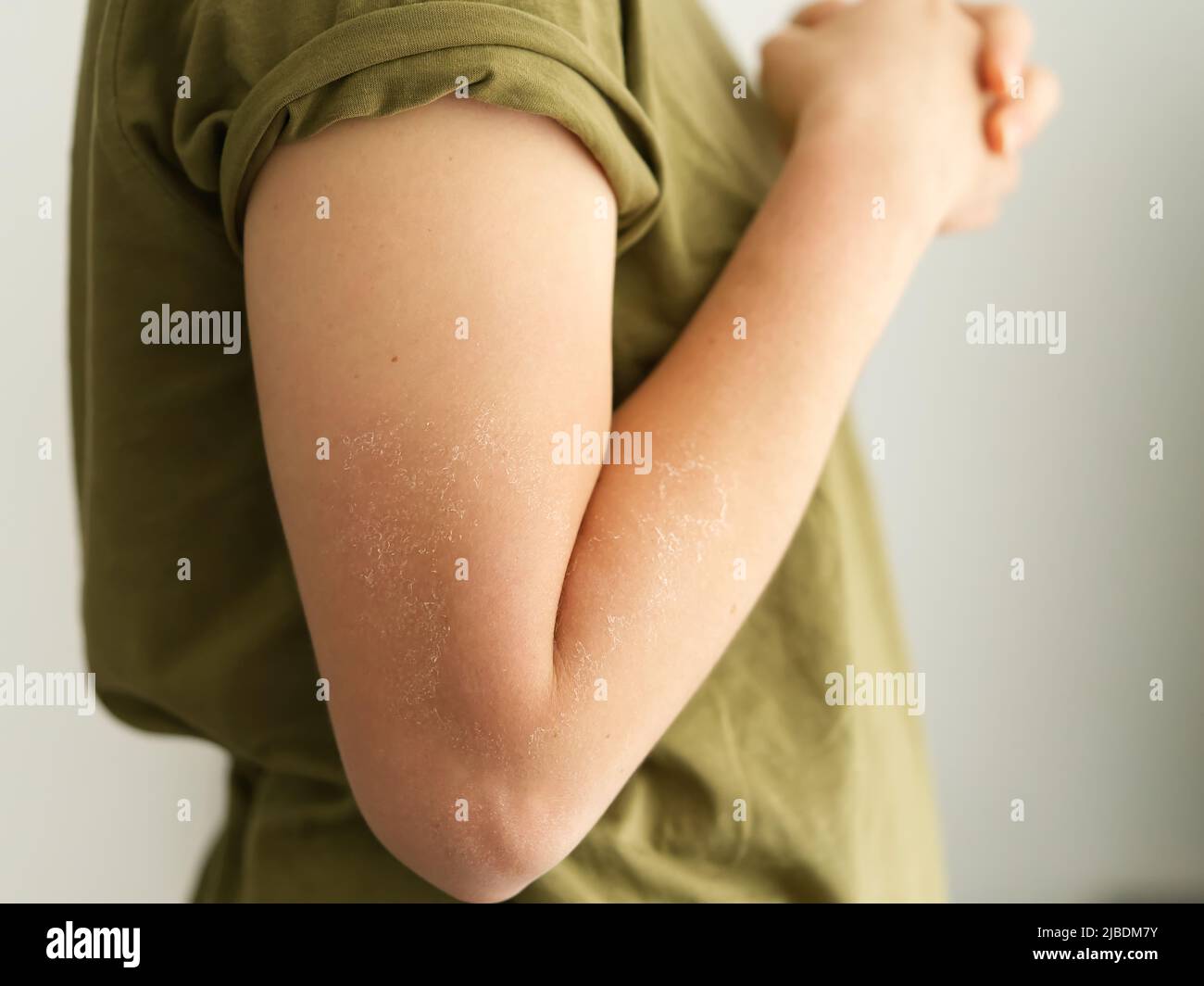 Peeling Skin At Shoulder From Sunburn Effect On Body Of Young Woman
