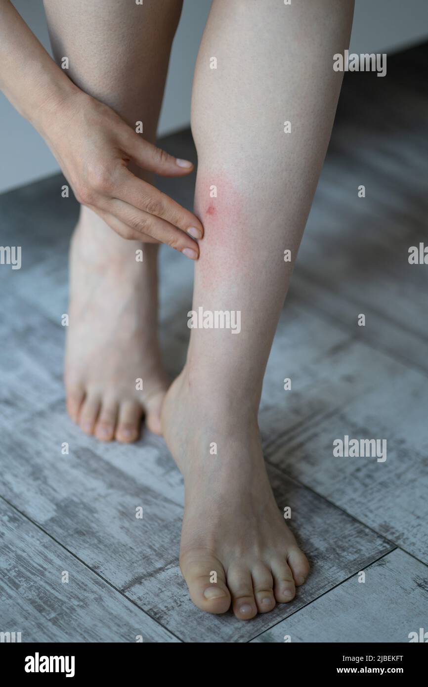 Asian female touches her leg after being bitten by mosquito at home ...